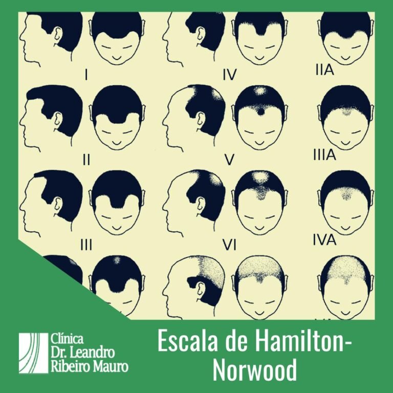 Escala de Hamilton-Norwood - Transplante Capilar Curitiba
